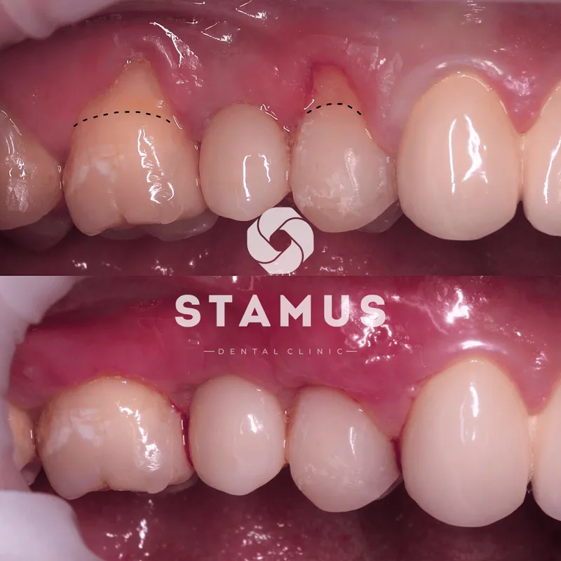 Пластика десны в Краснодаре – Цены на гингивопластику в стоматологии Стамус